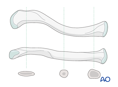 Anterior approach to the clavicle
