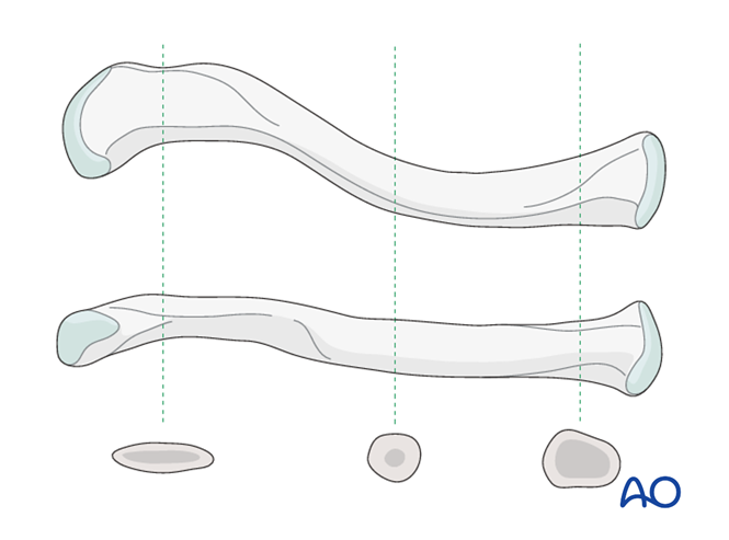 Anterior approach to the clavicle