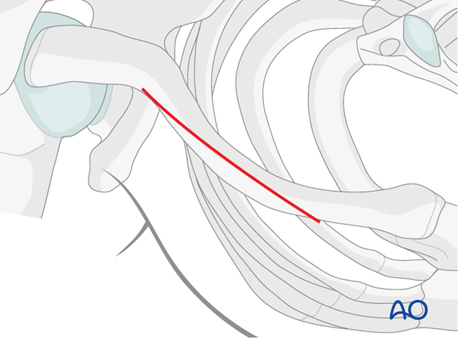 Superior approach to the clavicle