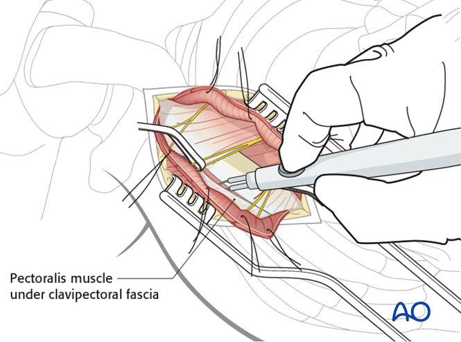 Superior approach to the clavicle