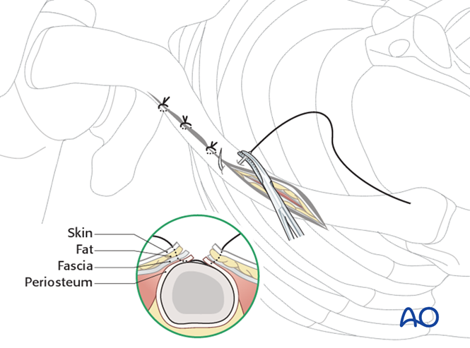 Superior approach to the clavicle