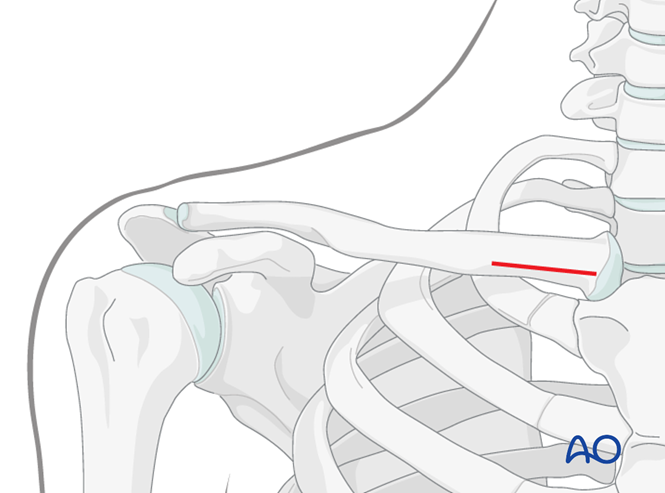 Nailing approach to the clavicle