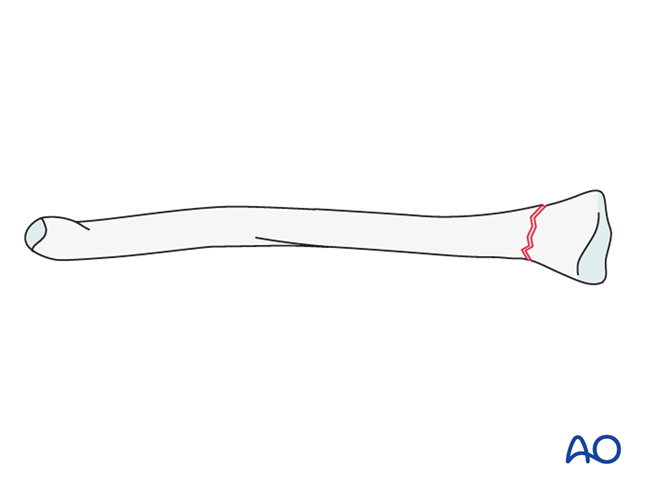 Medial, extraarticular clavicle fracture