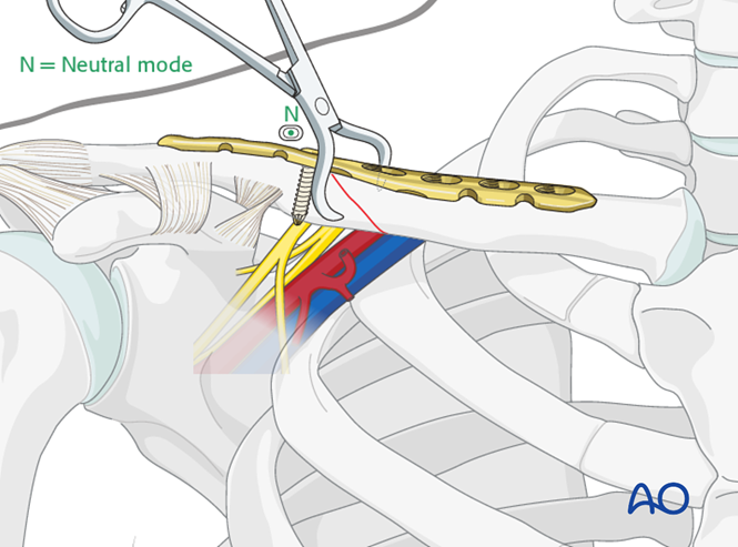 ORIF - Compression plate with lag screw for Diaphyseal simple, oblique ...