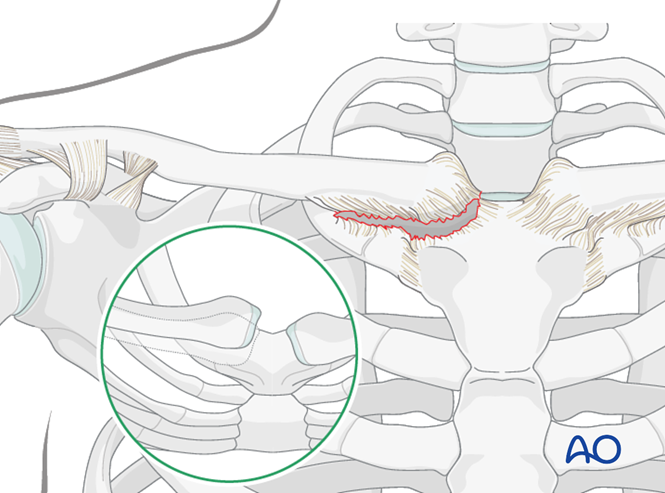 Reduction of sternoclavicular dislocation for Medial, articular ...