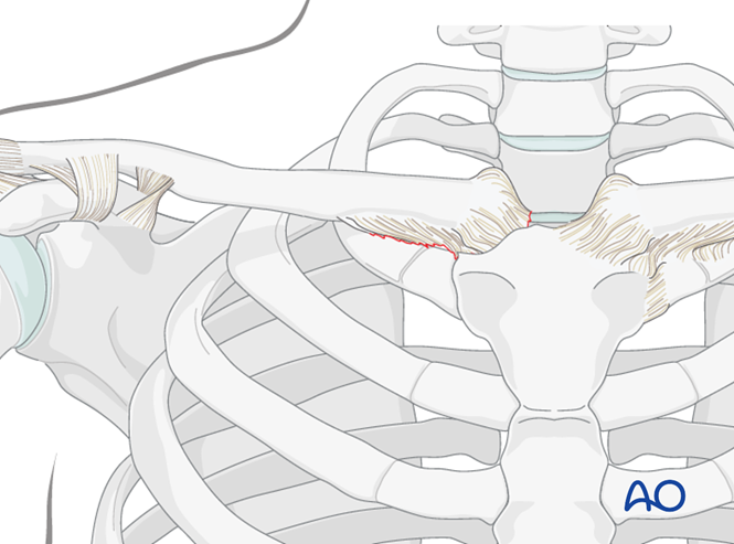 Reduction of sternoclavicular dislocation for Medial, articular ...