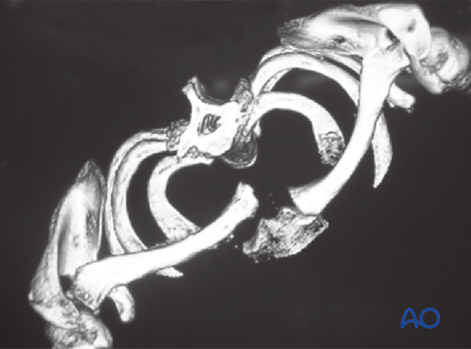 Reduction of sternoclavicular dislocation for Medial, articular ...