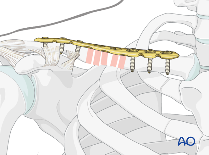 ORIF - Bridge plate for Diaphyseal multifragmentary, fragmentary ...