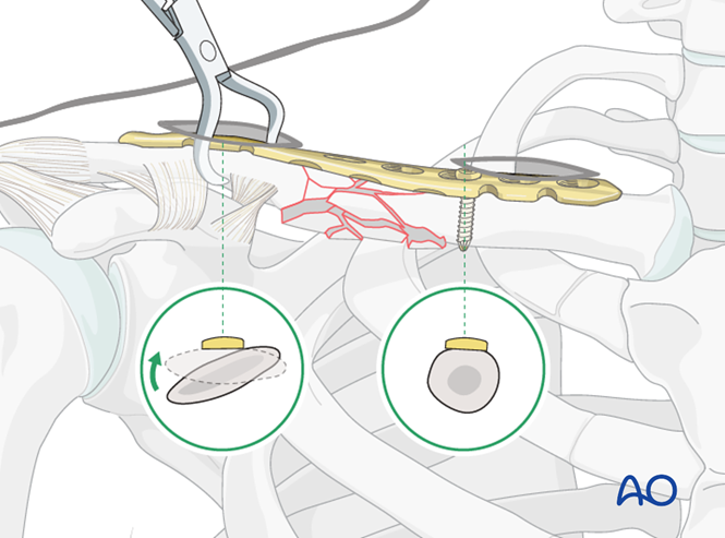 MIO - Bridge plate for Diaphyseal multifragmentary, fragmentary ...
