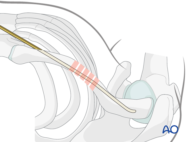 Flexible intramedullary nail for Diaphyseal simple, transverse clavicle ...