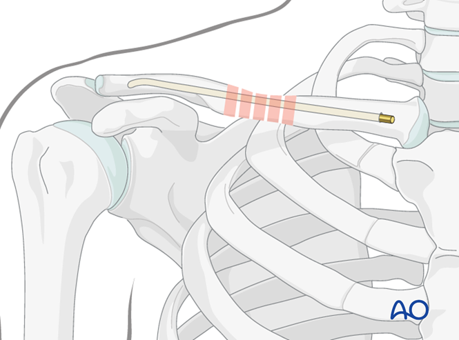Flexible intramedullary nail for Diaphyseal simple, transverse clavicle ...