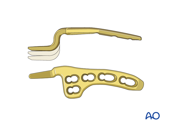 ORIF - Hook plate for Lateral, displaced fracture with CC disrupted ...