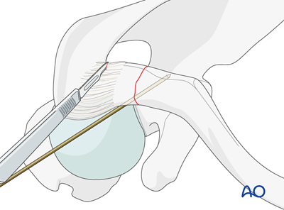 ORIF - Hook plate for Lateral, displaced fracture with CC disrupted ...