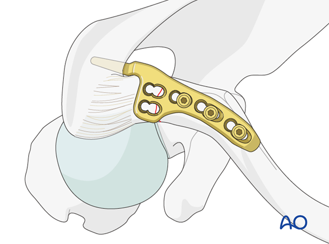 ORIF - Hook plate for Lateral, displaced fracture with CC disrupted ...