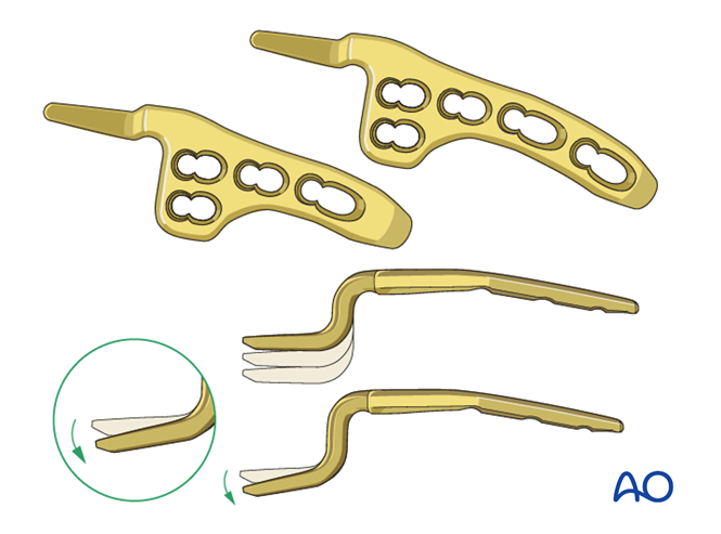 ORIF - Hook plate for Lateral, displaced fracture with CC disrupted ...