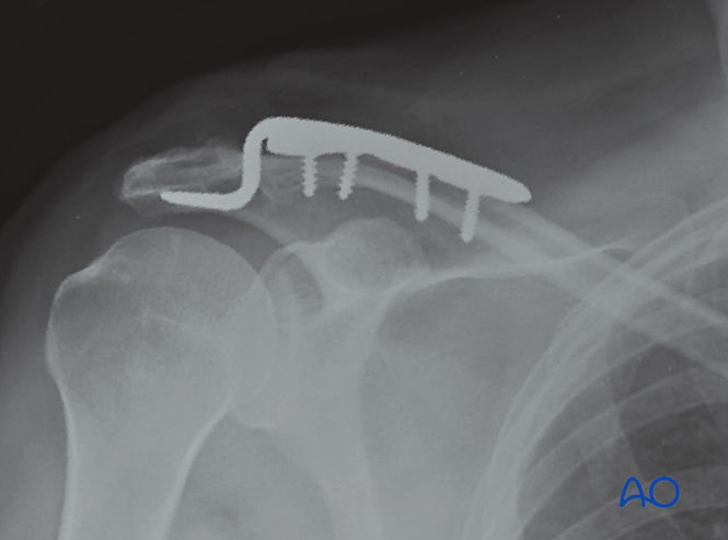 Fixation of complete LSSS Failure