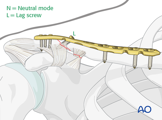 ORIF - Pre-contoured distal plate for Lateral, displaced fracture with ...
