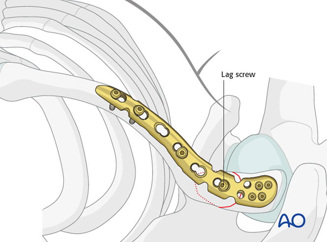 ORIF - Pre-contoured distal plate for Lateral, displaced fracture with ...