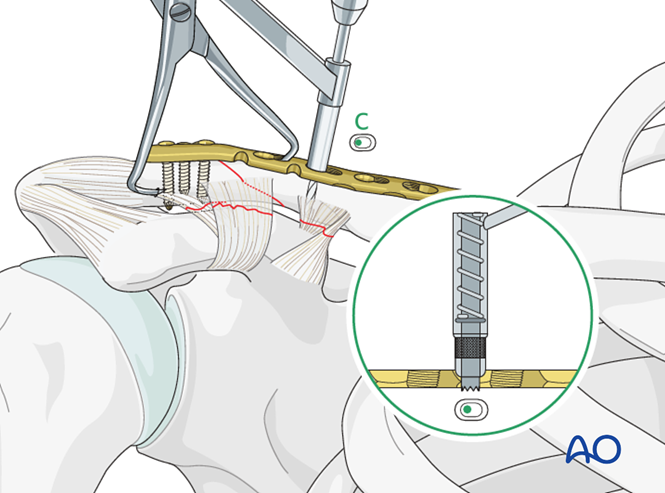 ORIF - Pre-contoured distal plate for Lateral, displaced fracture with ...