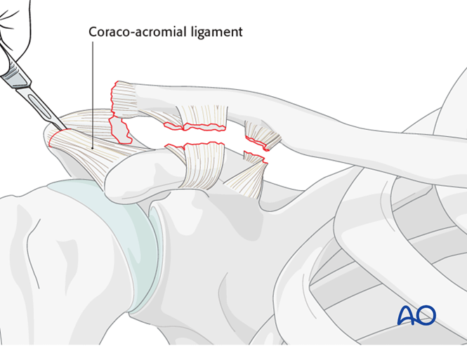 Ligament reconstruction