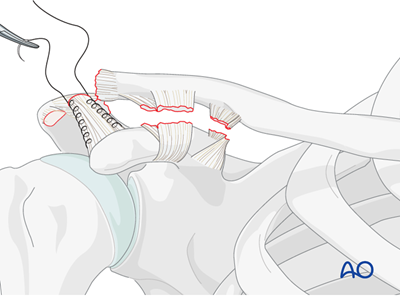Ligament reconstruction