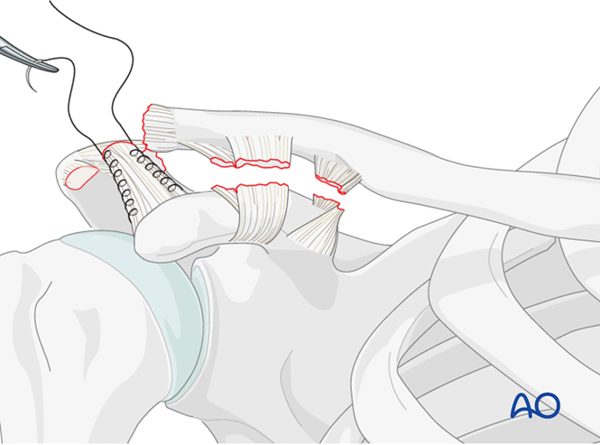 Ligament reconstruction