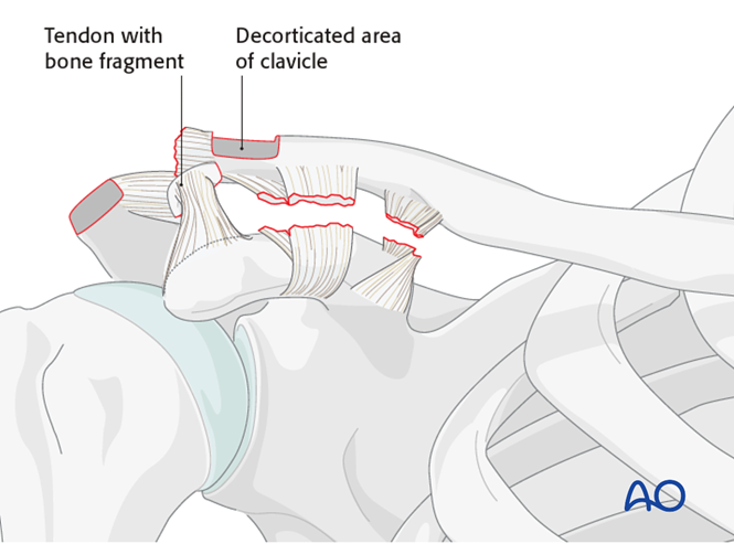 Ligament reconstruction