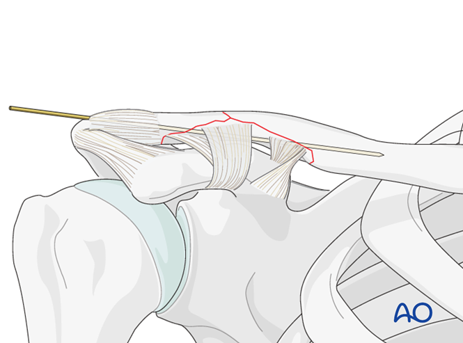 ORIF - Pre-contoured distal plate for Lateral, displaced fracture with ...