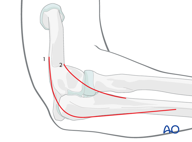 Posterolateral approach to the proximal forearm