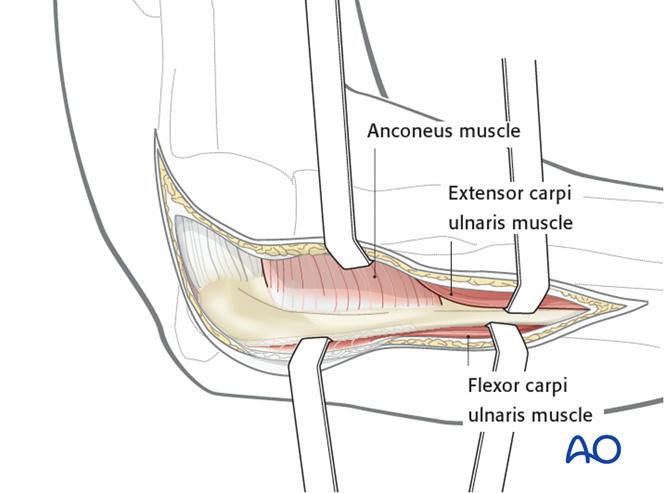 Posterolateral approach to the proximal forearm