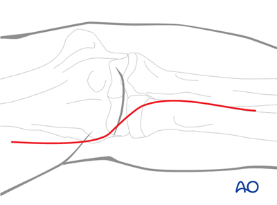 Anterior approach to the proximal forearm