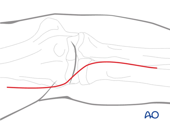 Anterior approach to the proximal forearm