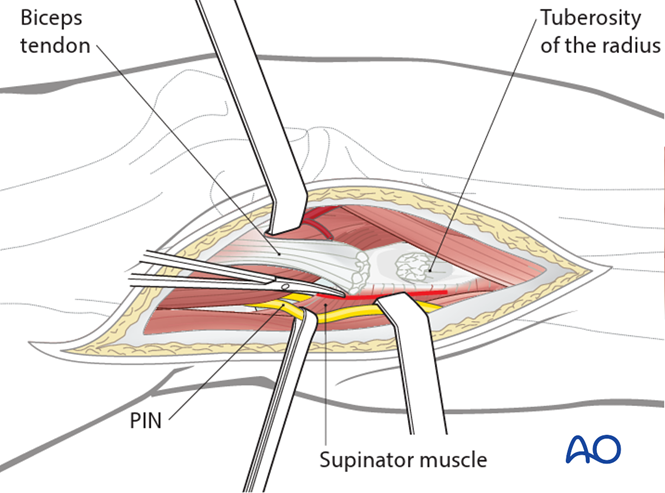 Anterior approach to the proximal forearm