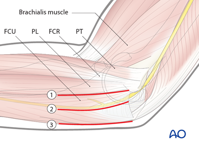 Medial approach to the proximal forearm: FCU split