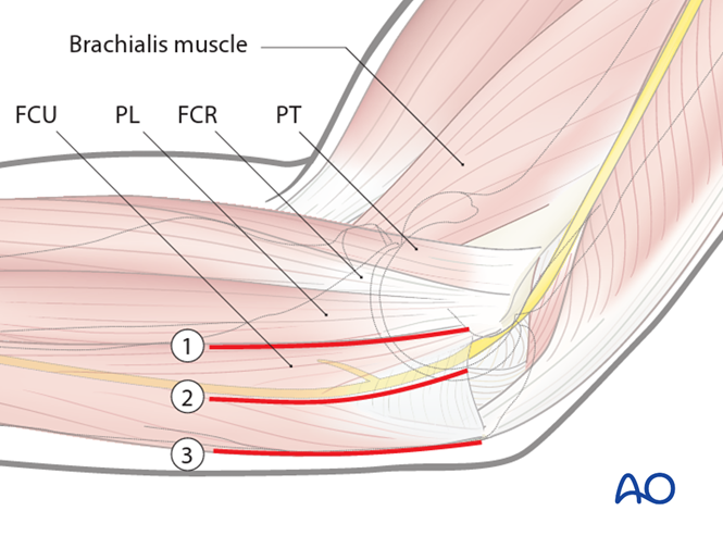 Medial approach to the proximal forearm: FCU split