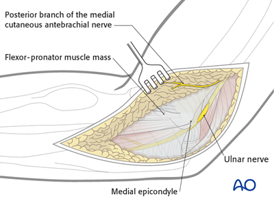 Medial approach to the proximal forearm: FCU split