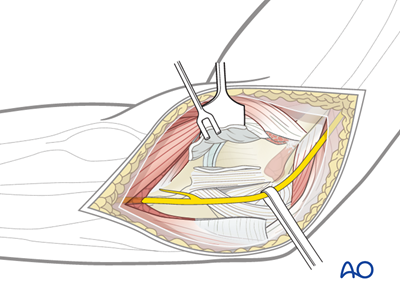 Medial approach to the proximal forearm: FCU split
