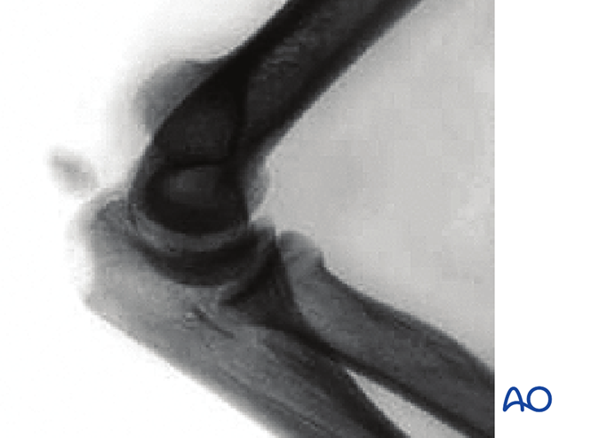 Ulna, extraarticular, avulsion of triceps insertion