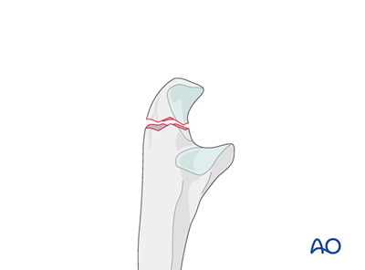 Ulna, articular, olecranon