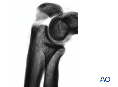 Ulna, articular, olecranon