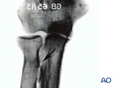 Radius, extraarticular, avulsion of bicipital tuberosity