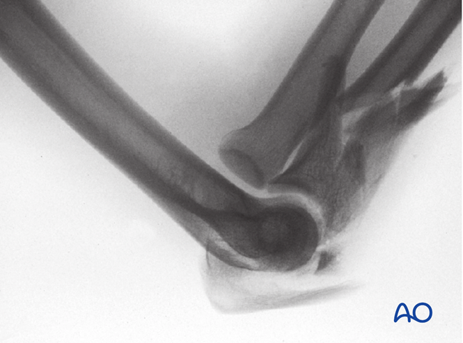 Anterior transolecranon fracture dislocation