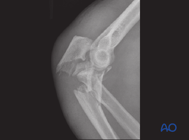Posterior olecranon fracture dislocation