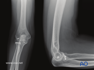 Lag screw for Radius, partial articular