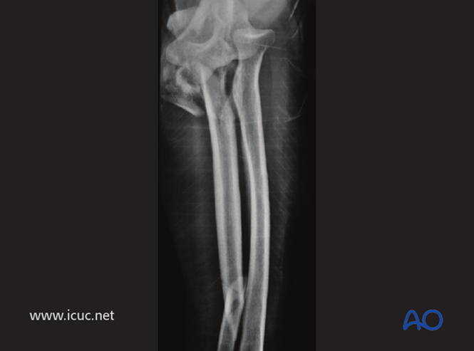 Open reduction internal fixation for Anterior transolecranon fracture ...