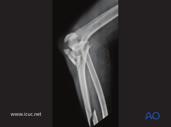 Open reduction internal fixation for Anterior transolecranon fracture ...