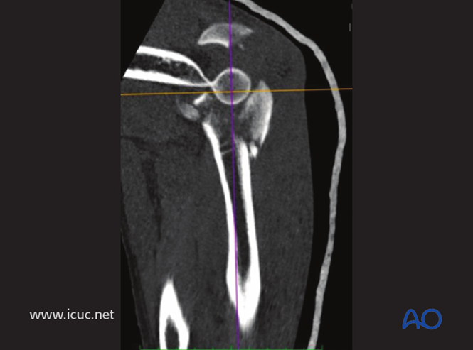 Open reduction internal fixation for Anterior transolecranon fracture ...