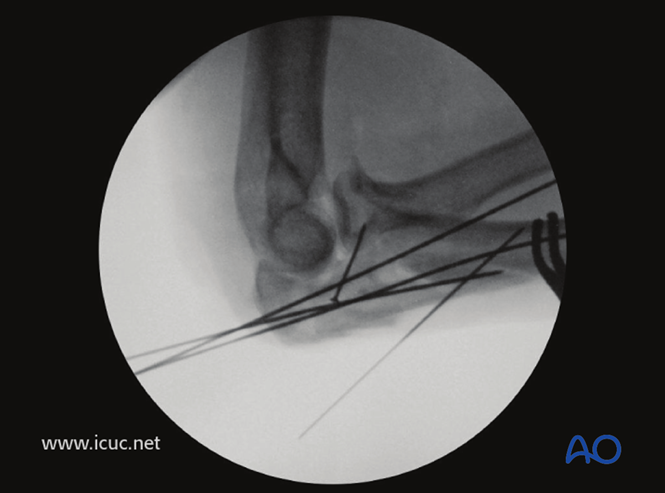 Open reduction internal fixation for Anterior transolecranon fracture ...