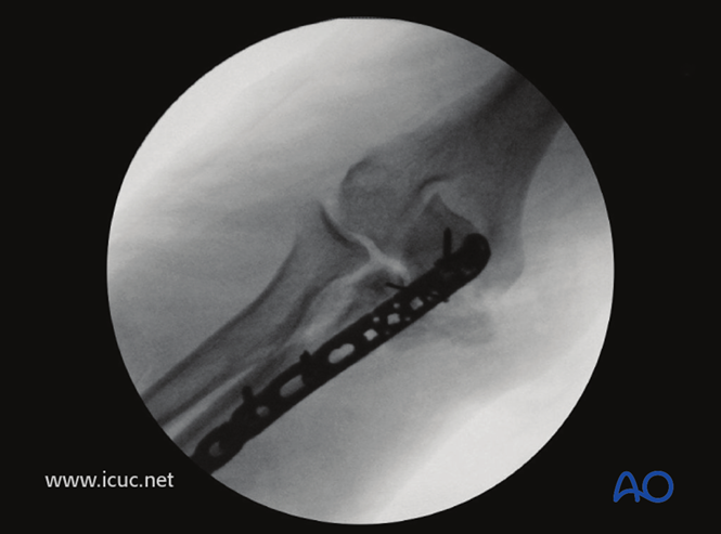 Open reduction internal fixation for Anterior transolecranon fracture ...