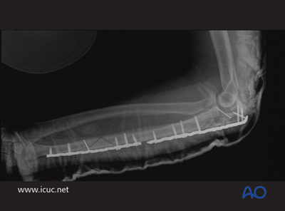 Open reduction internal fixation for Anterior transolecranon fracture ...